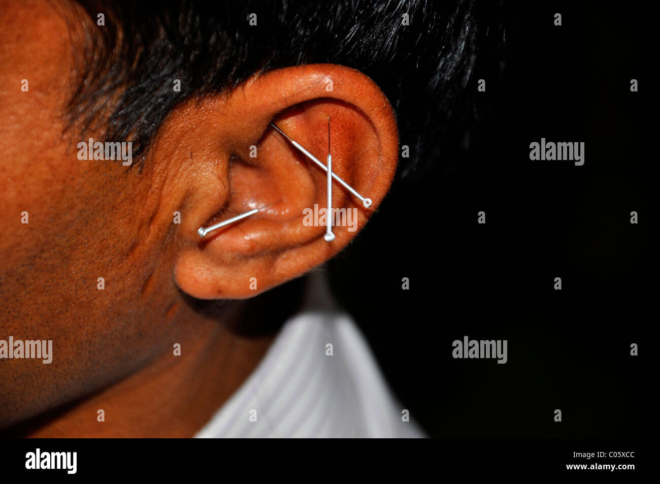 Ear acupuncture hi-res stock photography and images - Alamy