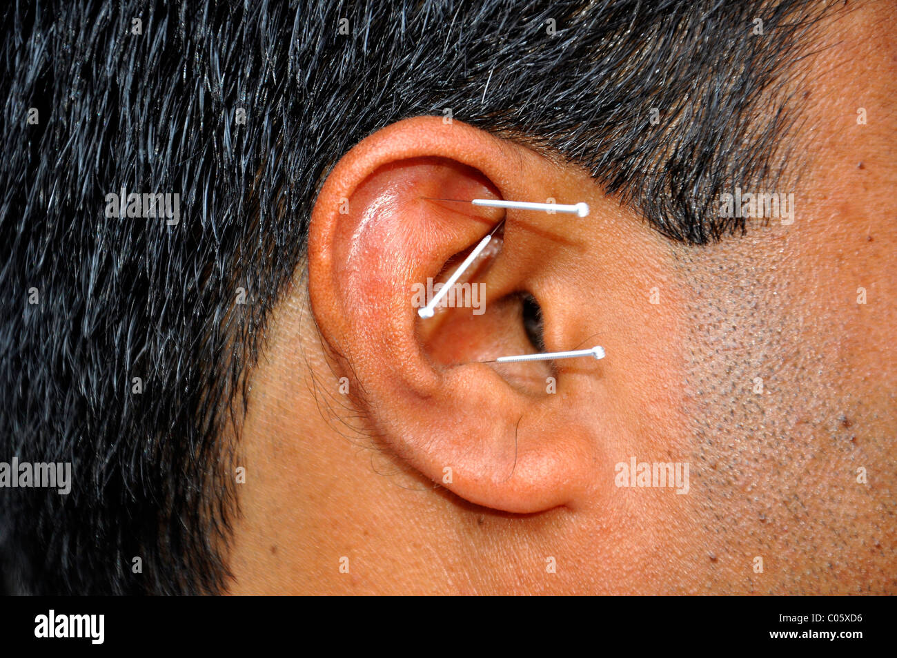 Ear acupuncture hi-res stock photography and images - Alamy