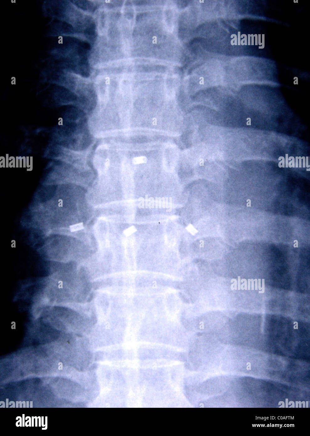 SPRINGS FOUND IN 'SORE BACK' WOMAN A woman has had five rusty springs ...