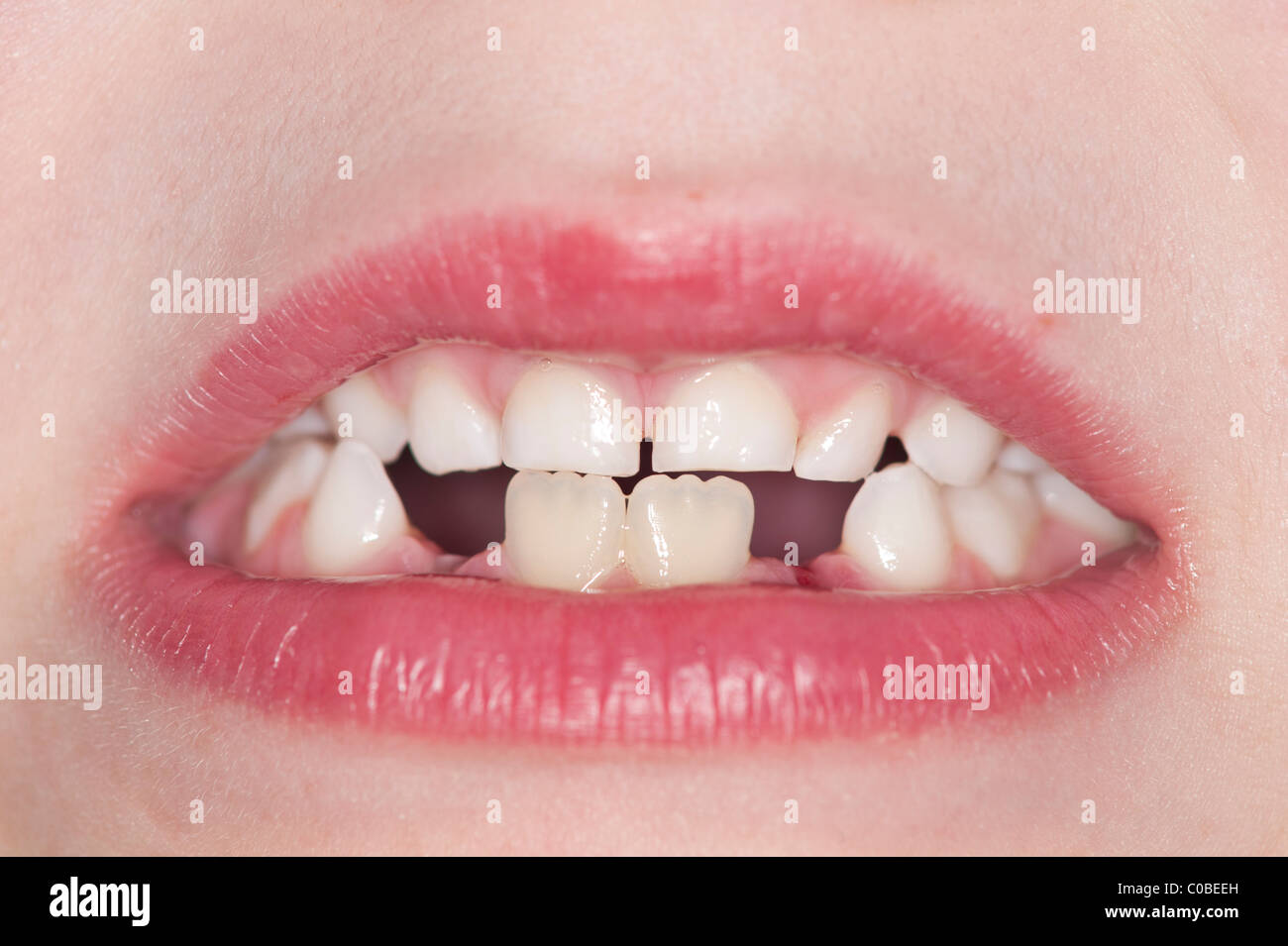 A MODEL RELEASED boy of seven shows his gappy teeth close up Stock ...