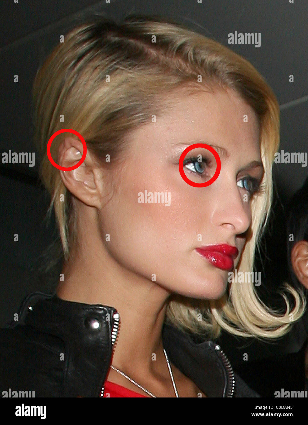 Paris Hilton showing a cauliflower ear and ill-fitting contact lenses ...