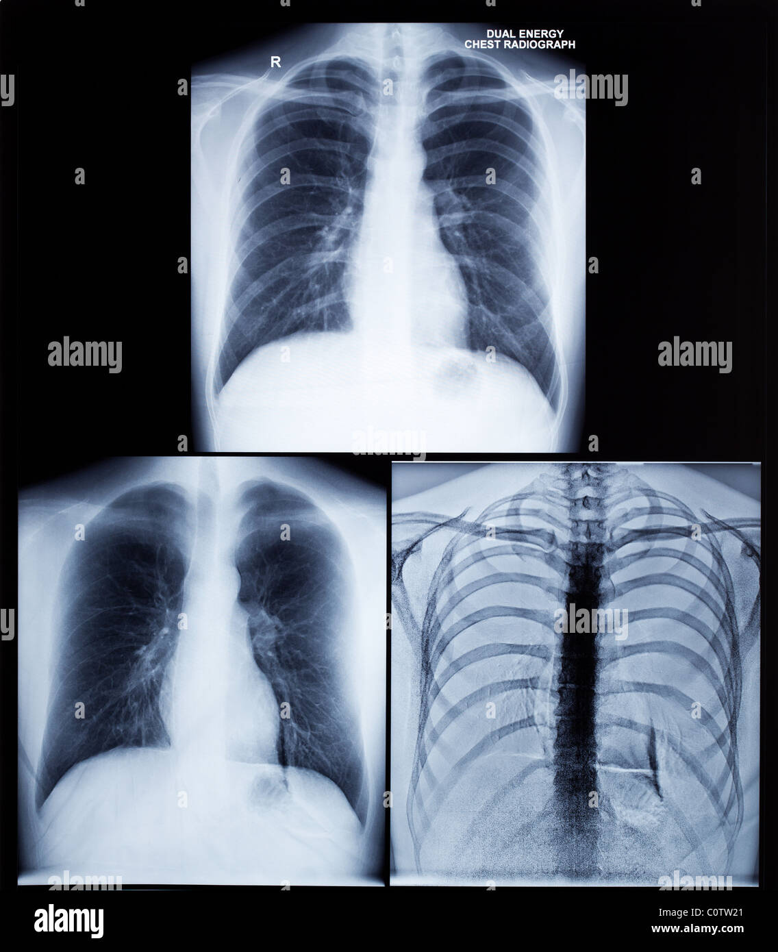Normal chest x ray hi-res stock photography and images - Alamy