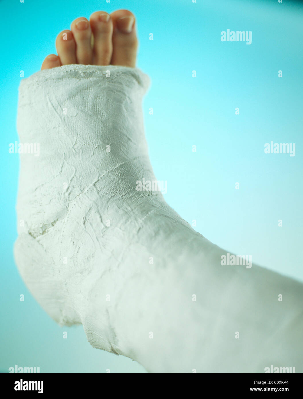 Plaster foot cast hi-res stock photography and images - Alamy