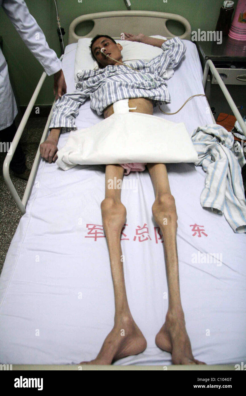 WALKING SKELETON DAYS FROM DEATH These horrifying pictures show the ...