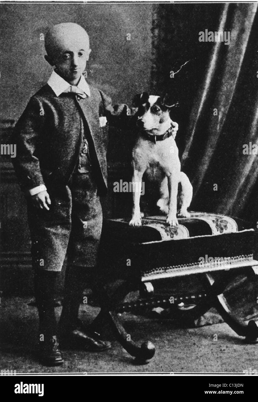 15 year old boy with Progeria, a rare children's disease that ...