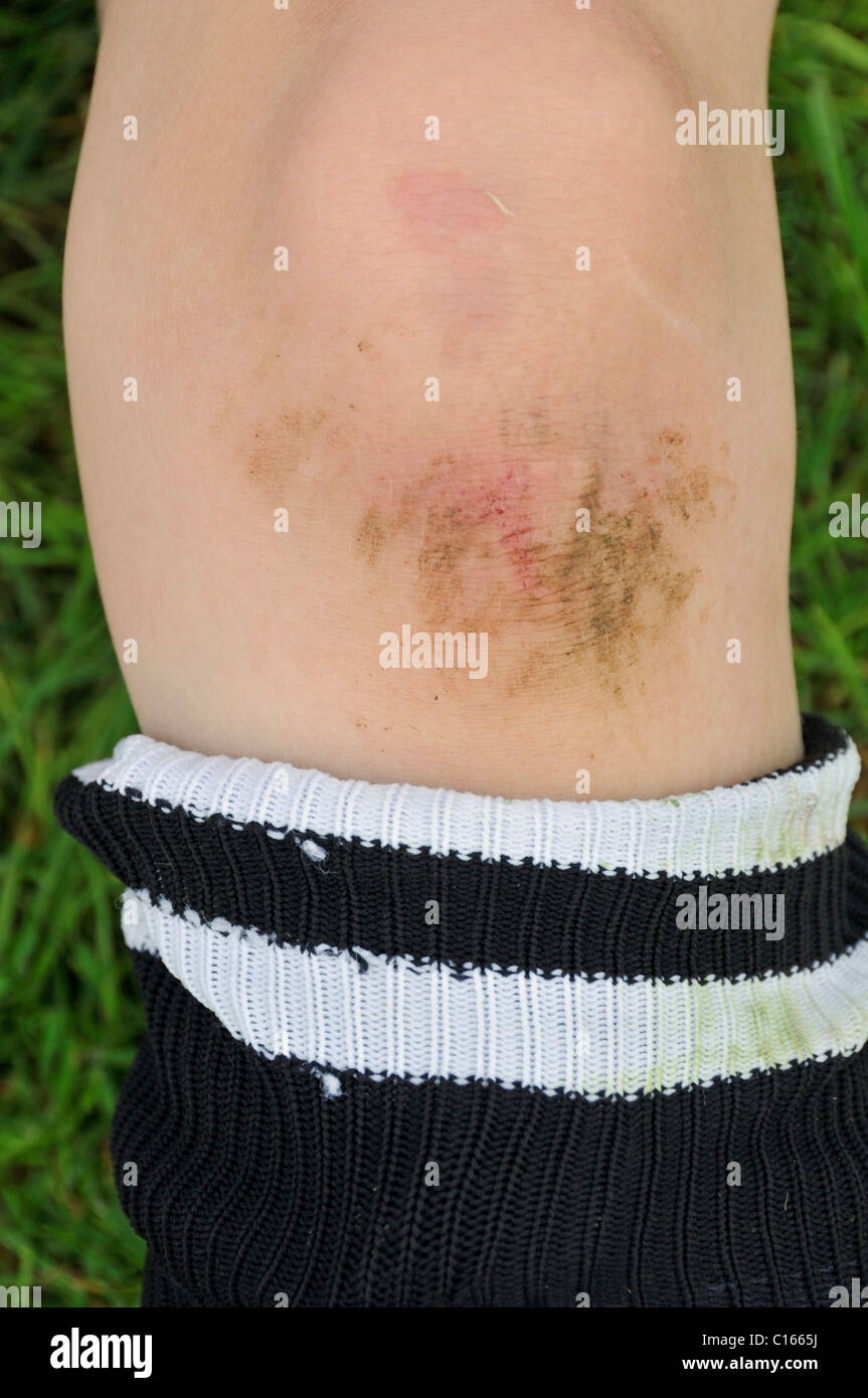 Child grazed knees hi-res stock photography and images - Alamy