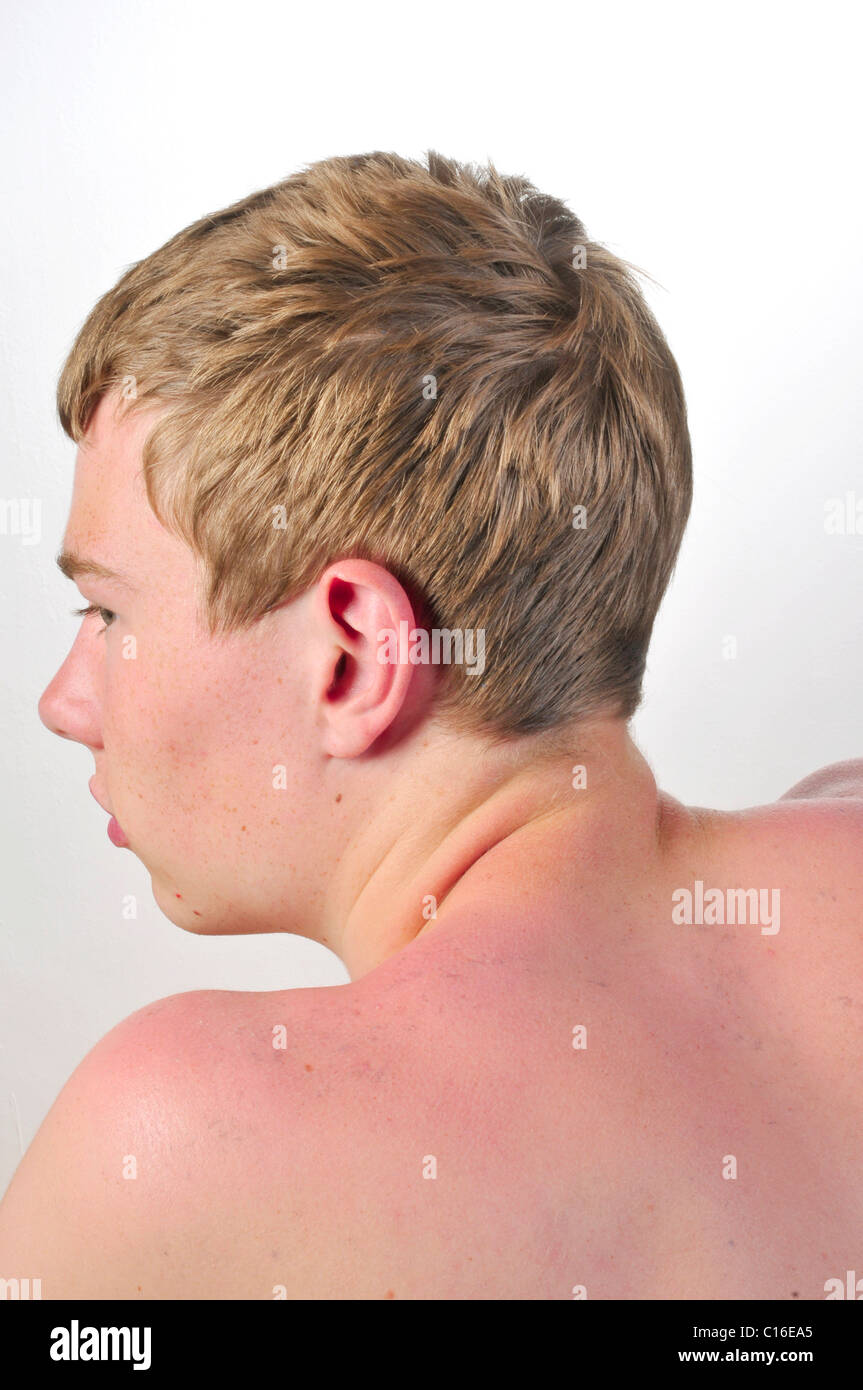 Young teen sunburn hi-res stock photography and images - Alamy