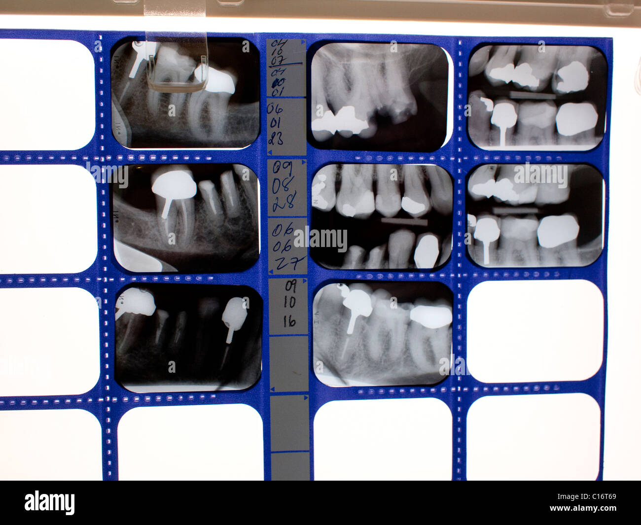 Teeth xray hi-res stock photography and images - Alamy