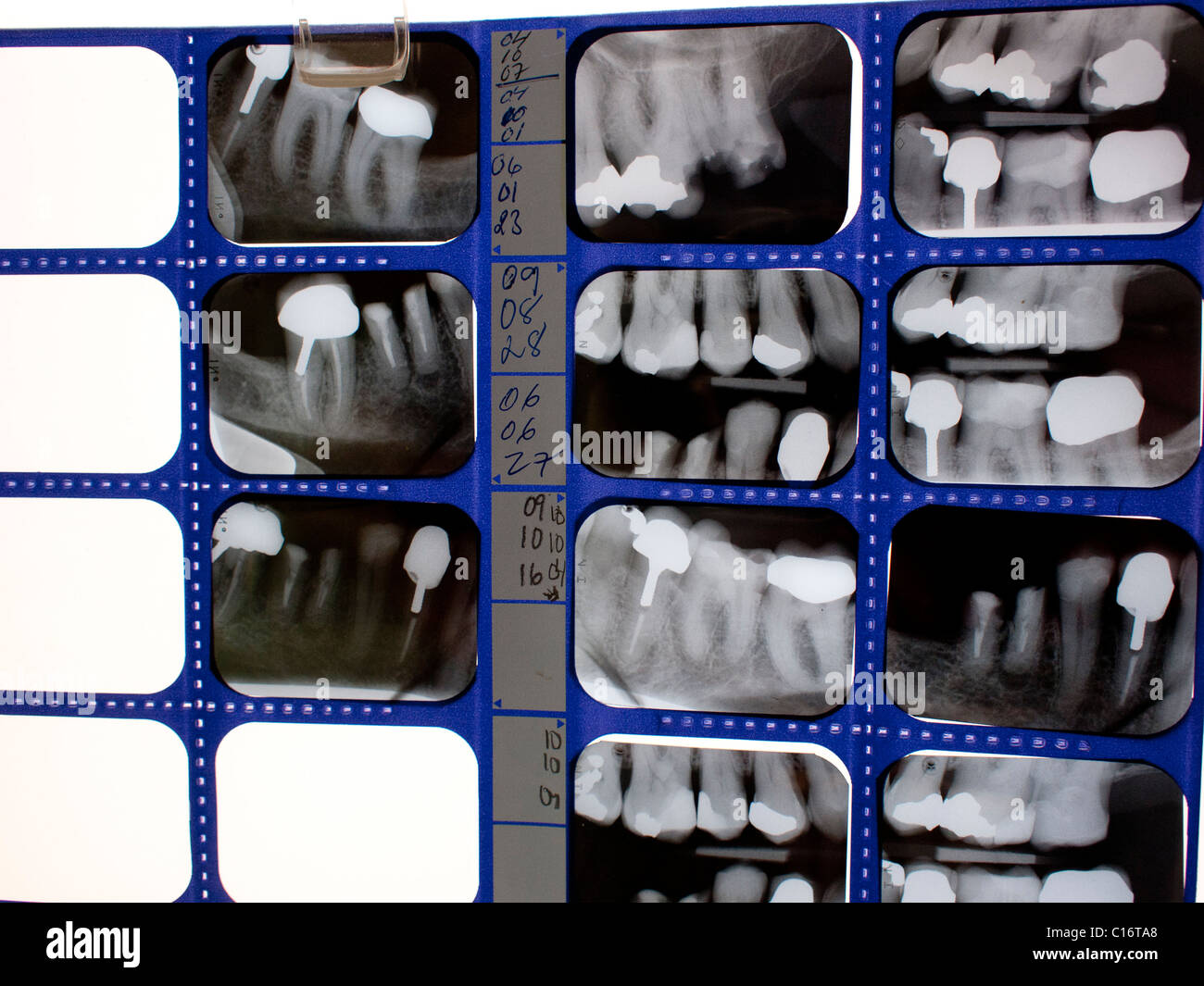 X-ray of patients teeth at dentist Stock Photo - Alamy