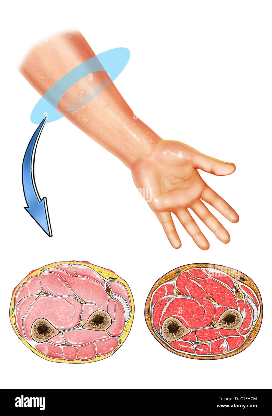 Compartment syndrome arm hi-res stock photography and images - Alamy