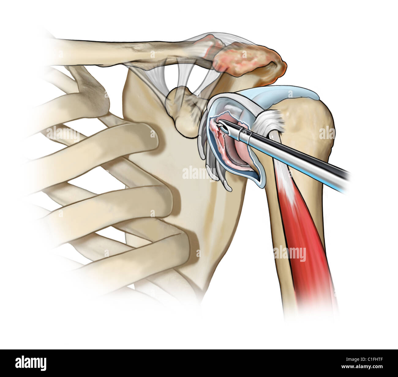 Rotator cuff labral repair hi-res stock photography and images - Alamy