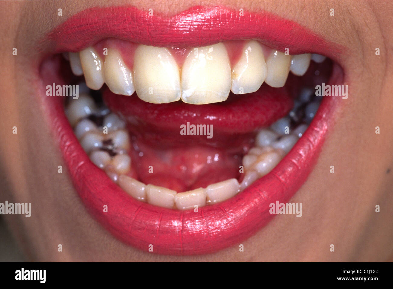 Amalgam fillings woman hi-res stock photography and images - Alamy