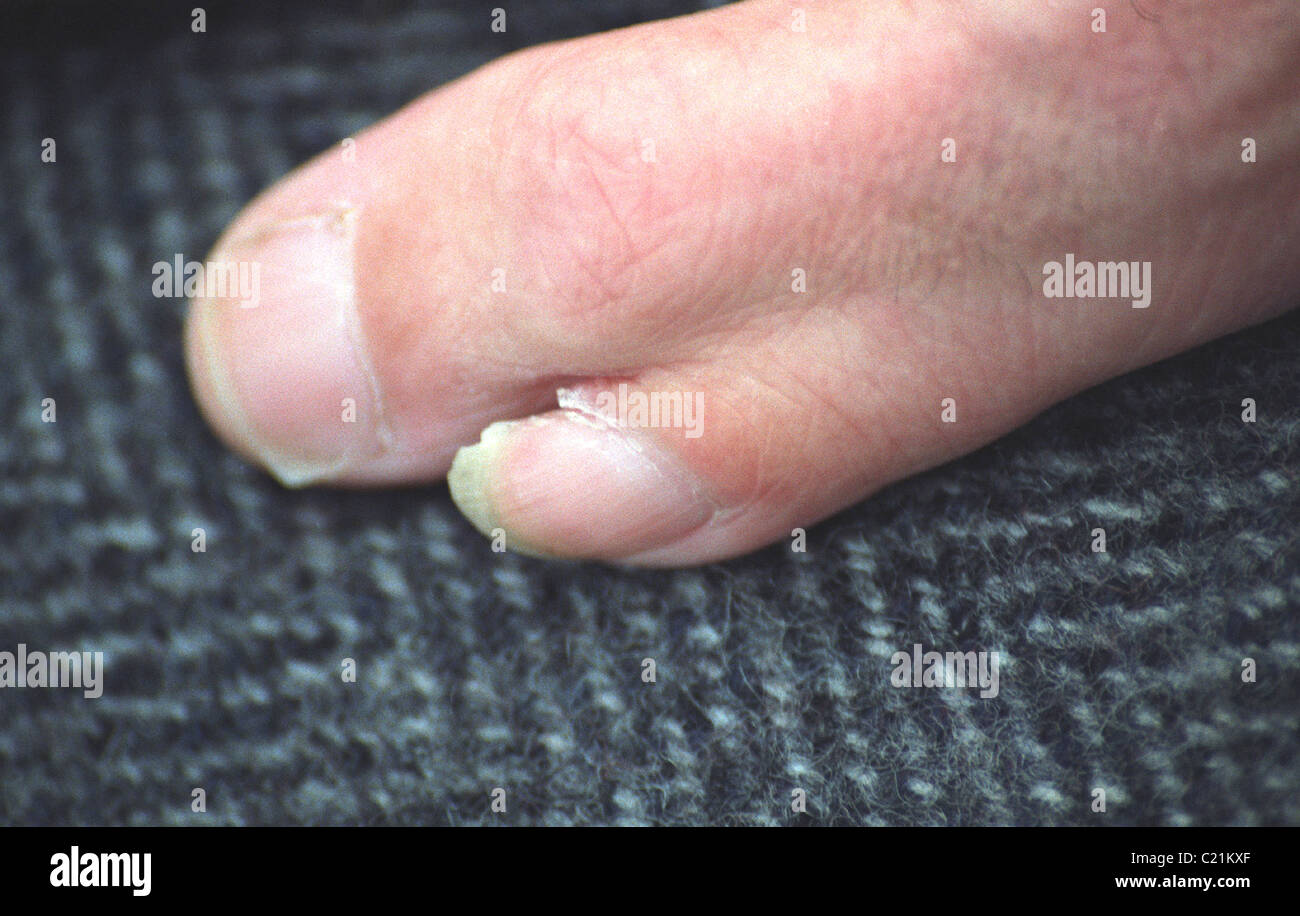 6-Fingered Man A man from Moscow, Russia, shows off his extra appendage ...