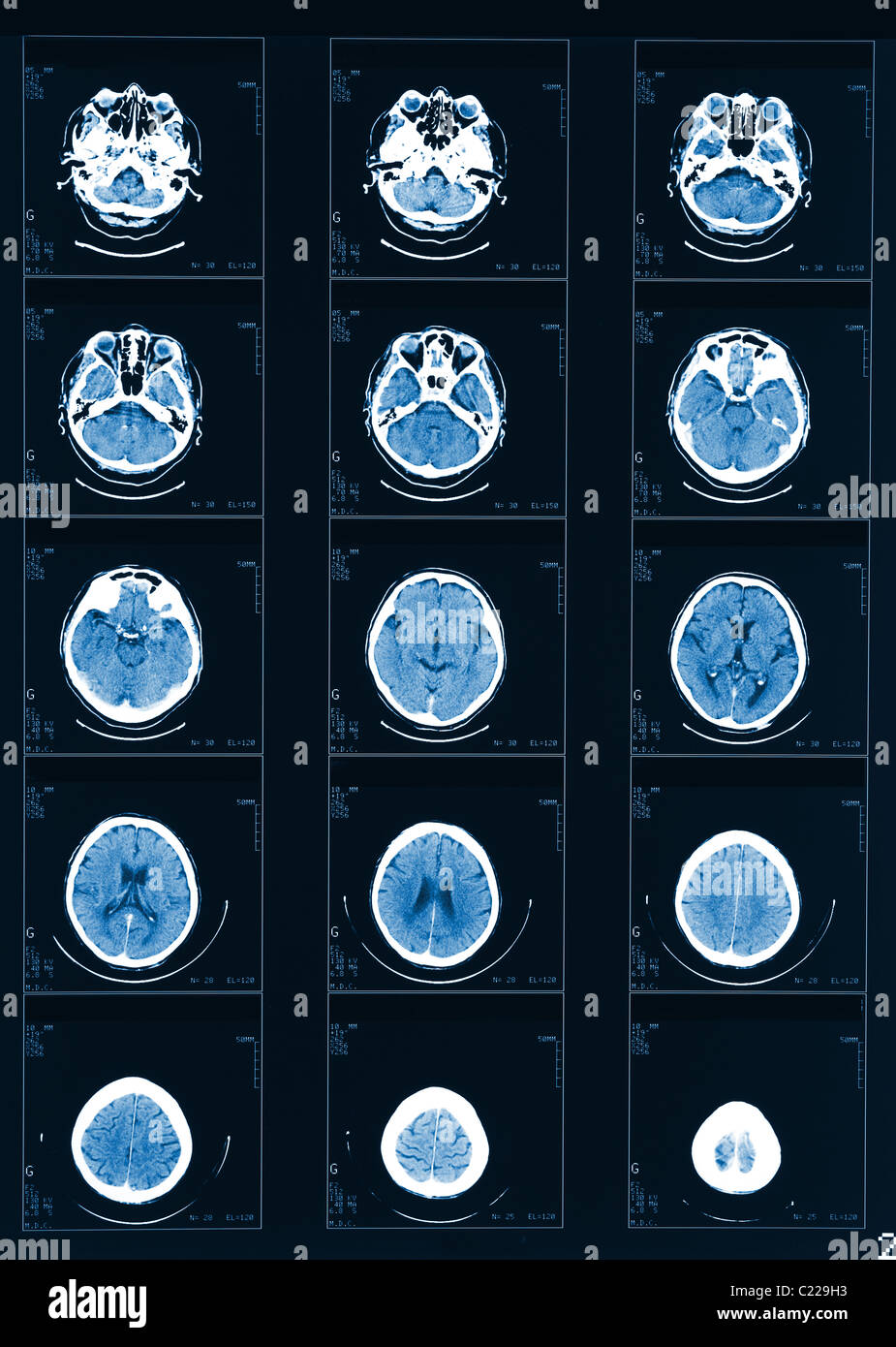 Computed tomography hi-res stock photography and images - Alamy