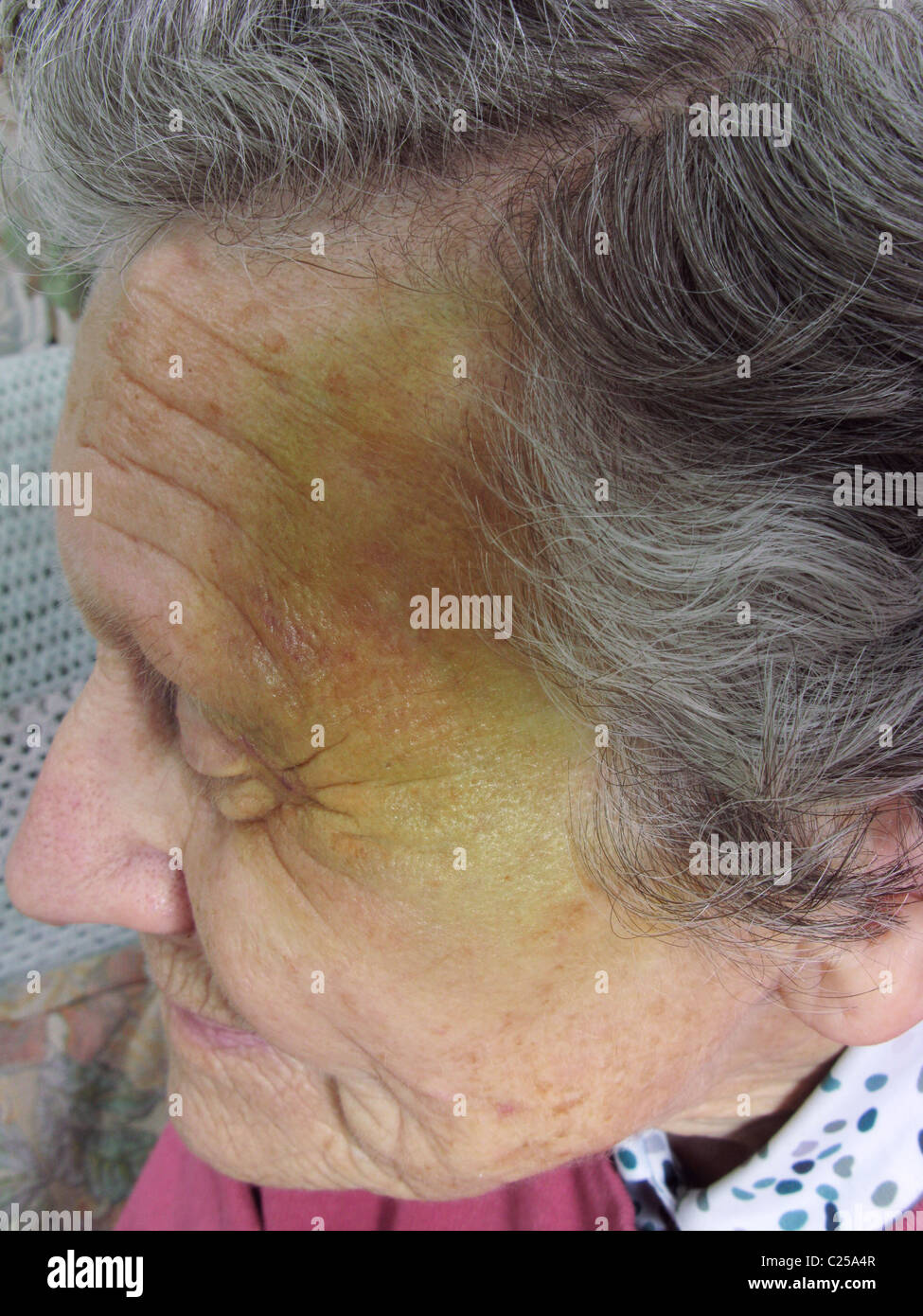 Woman With Bruised Face Stock Photos & Woman With Bruised Face Stock ...