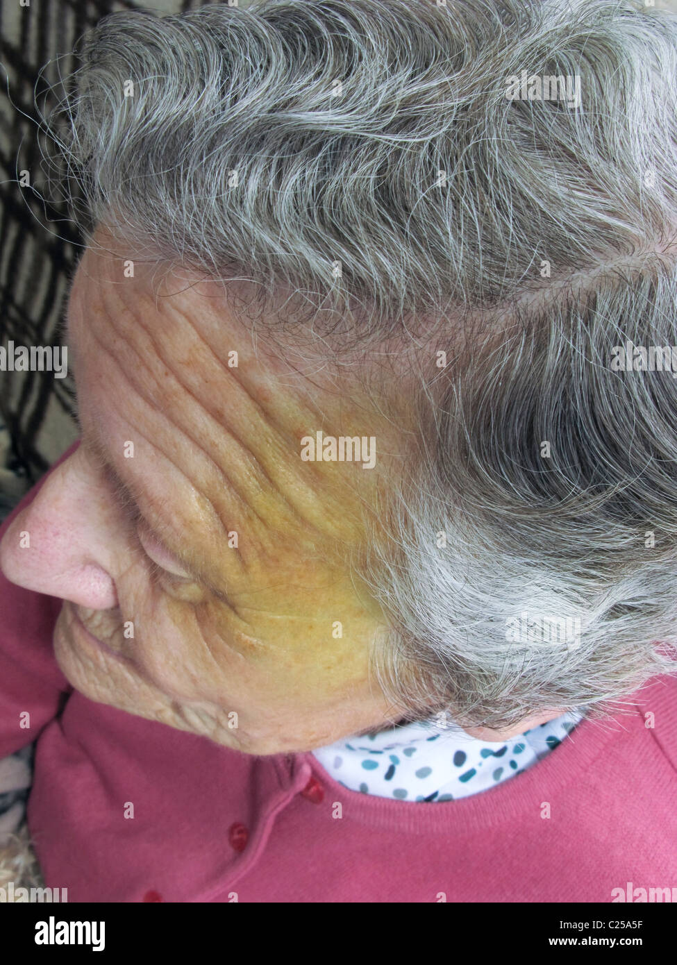 Bruised face hi-res stock photography and images - Alamy