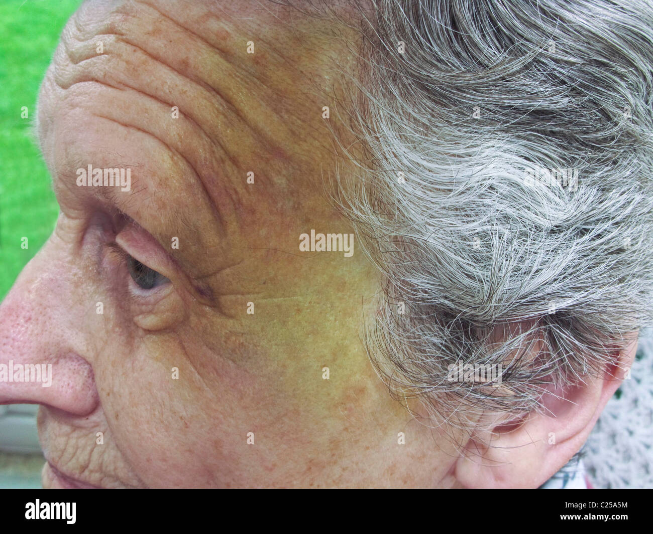 Bruise after a fall hi-res stock photography and images - Alamy