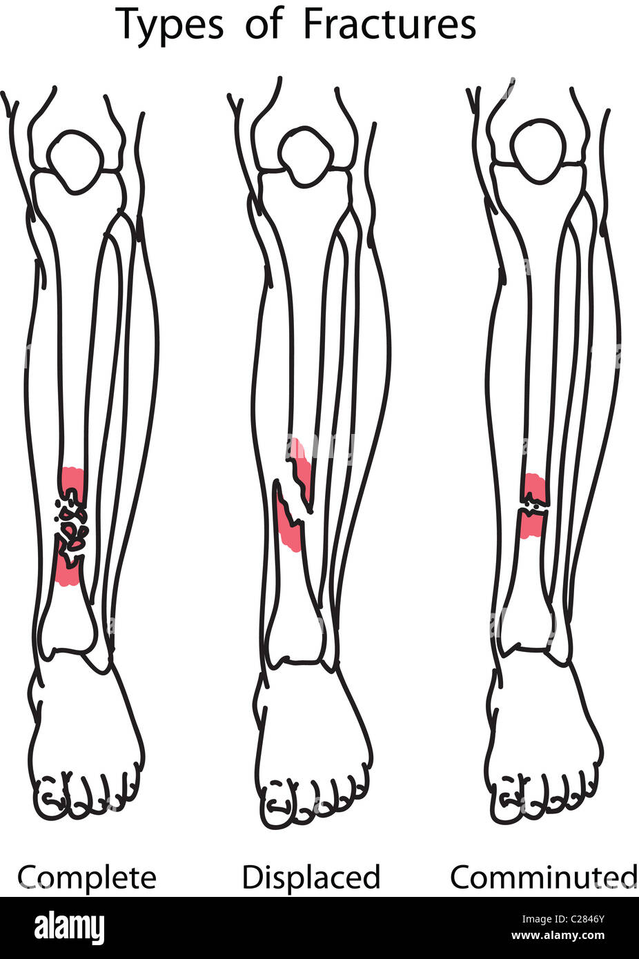 Types bone fractures hi-res stock photography and images - Alamy Types bone fractures hi-res stock photography and images - Alamy