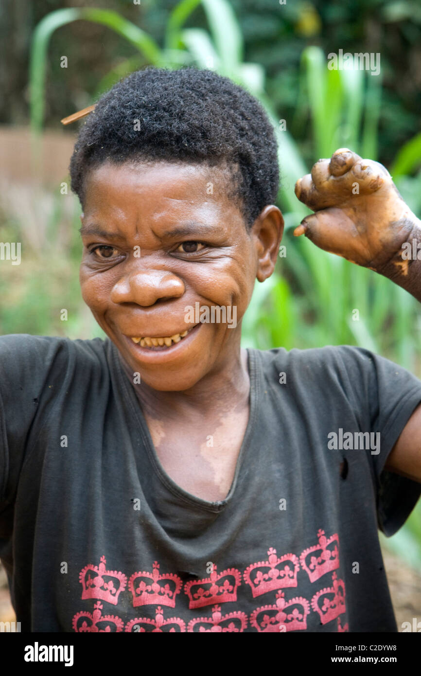 A smiling leprous pygmy in the forest,Republic of Congo Stock Photo - Alamy