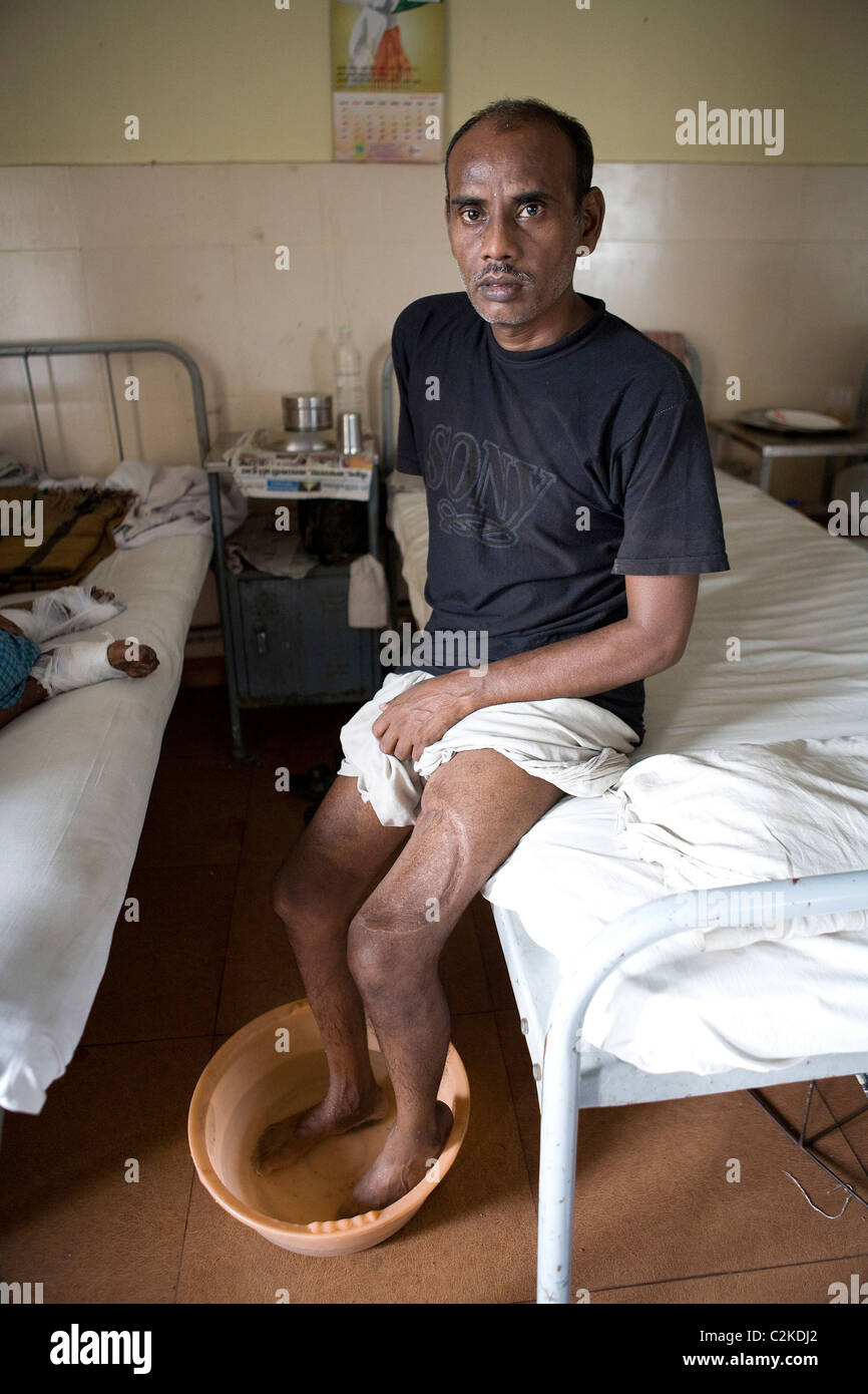 Leprosy patient is taking a bath to his feet at Premananda Leprosy ...