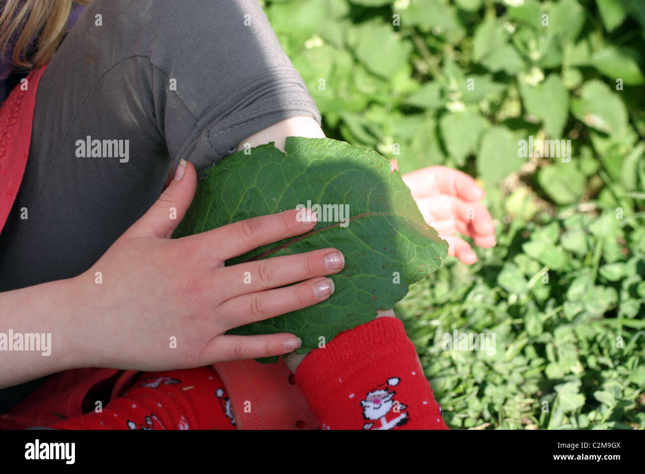 Nettle rash hi-res stock photography and images - Alamy
