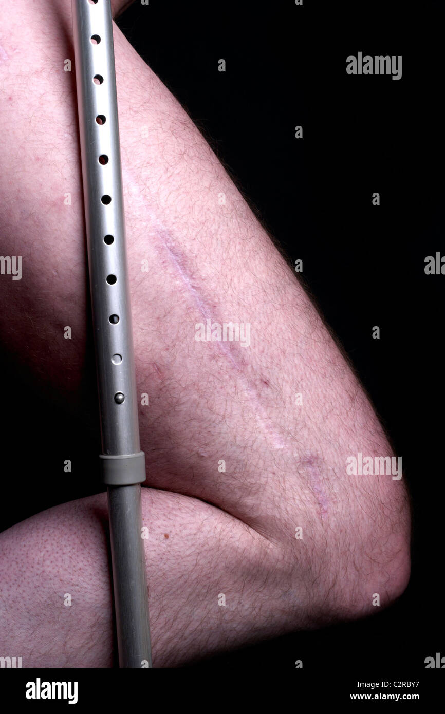 mans leg with long scar and crutch as a result of femur surgery Stock ...