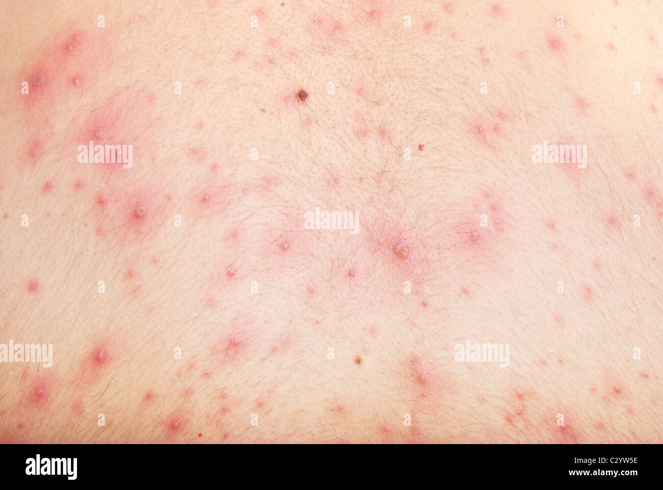 Chicken Pox Scars On Chest