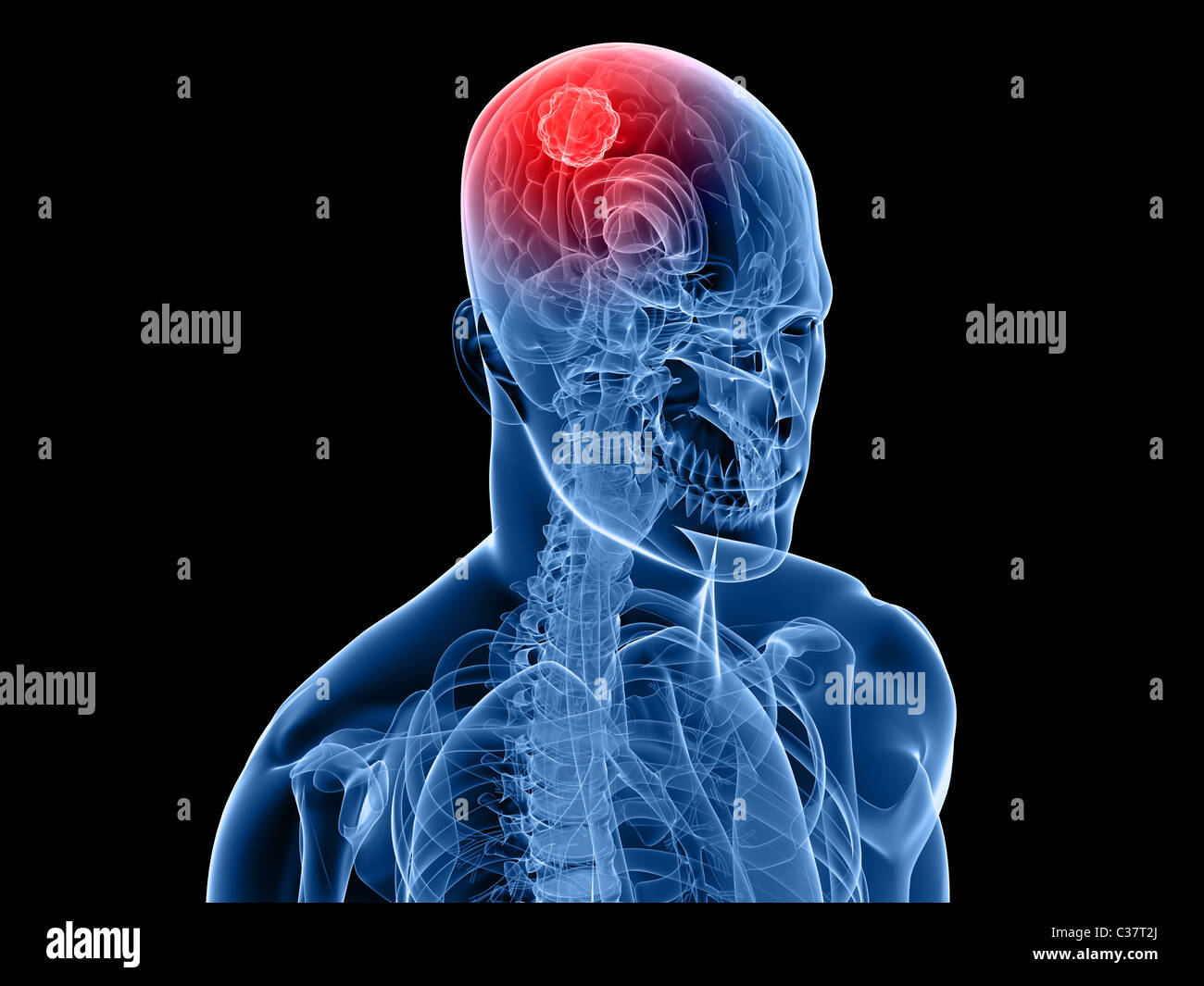 Brain tumor hi-res stock photography and images - Alamy