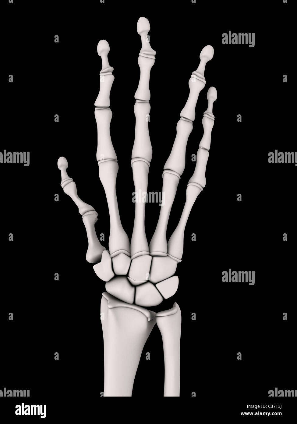x-ray hands - arthritis Stock Photo - Alamy
