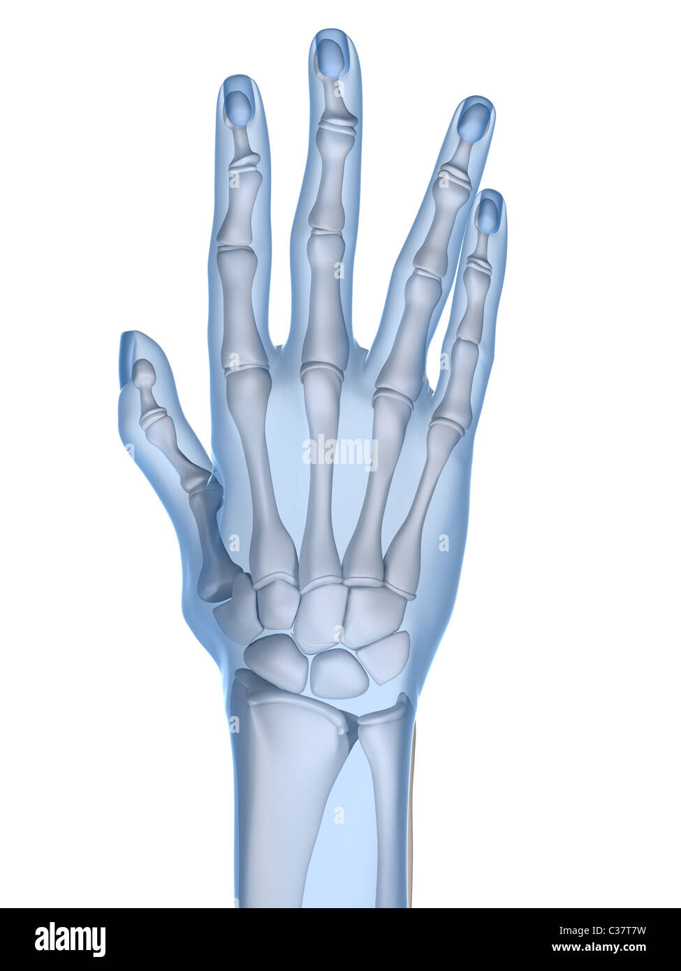 x-ray hands - arthritis Stock Photo - Alamy