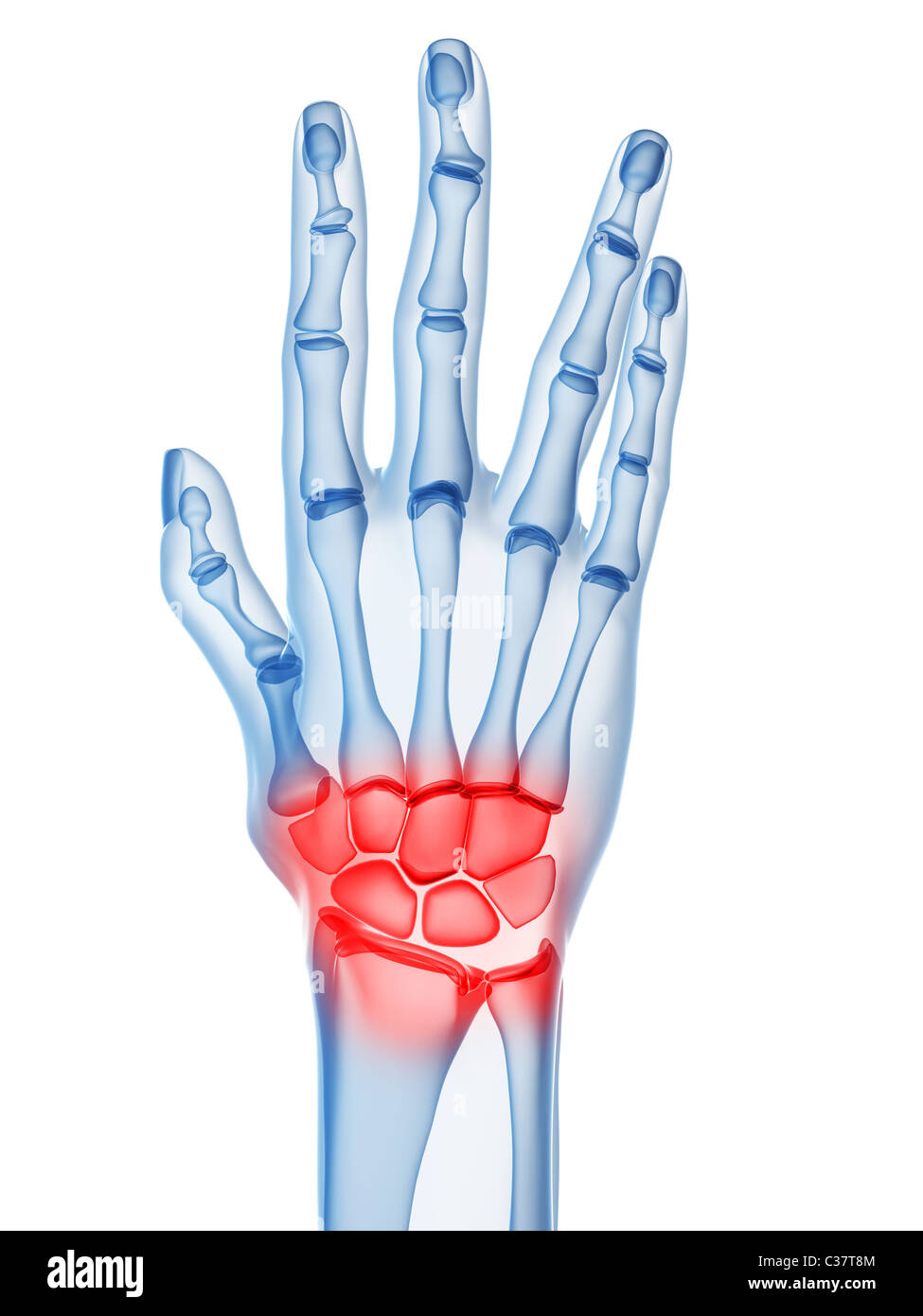 x-ray hands - arthritis Stock Photo - Alamy