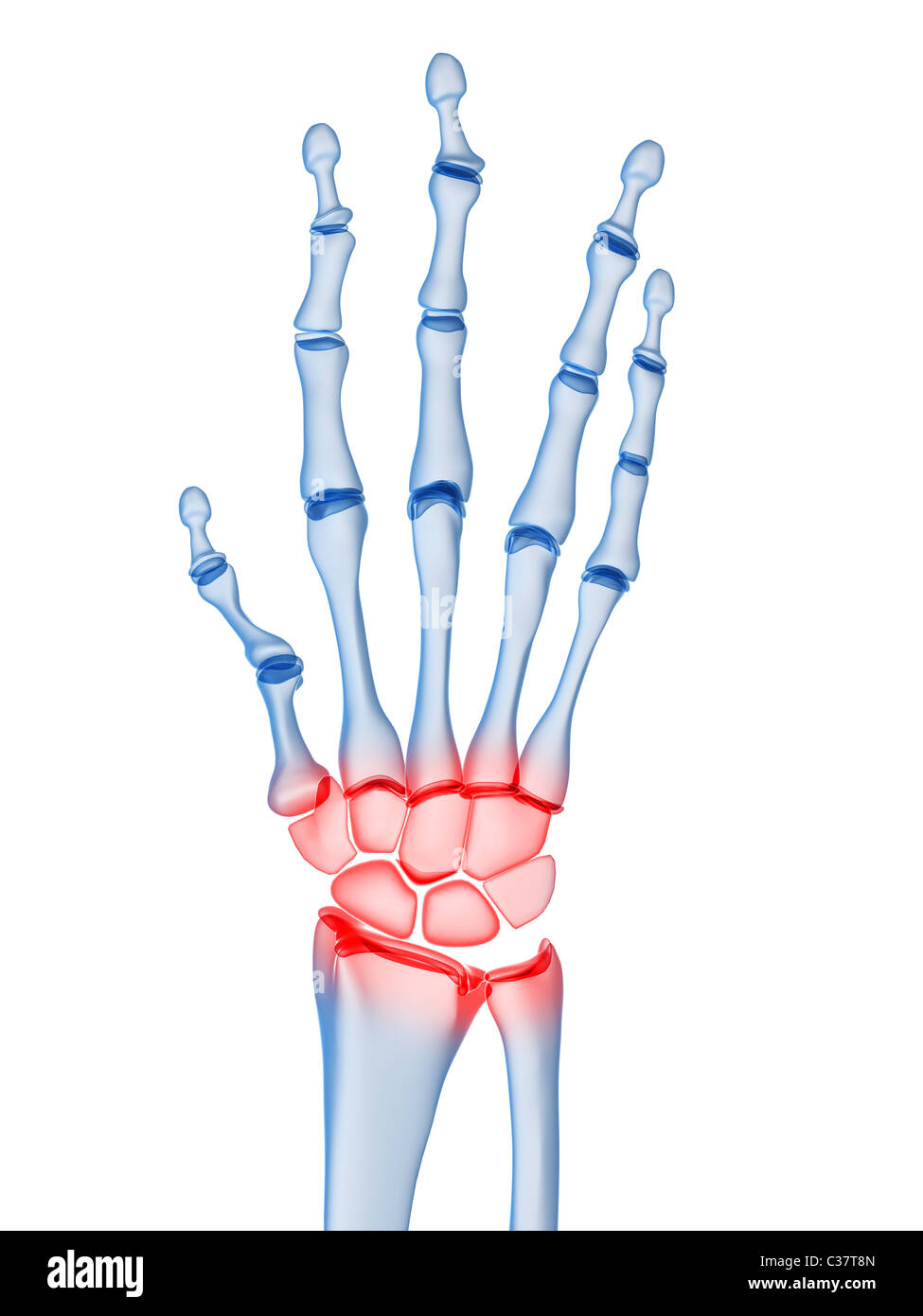 x-ray hands - arthritis Stock Photo - Alamy