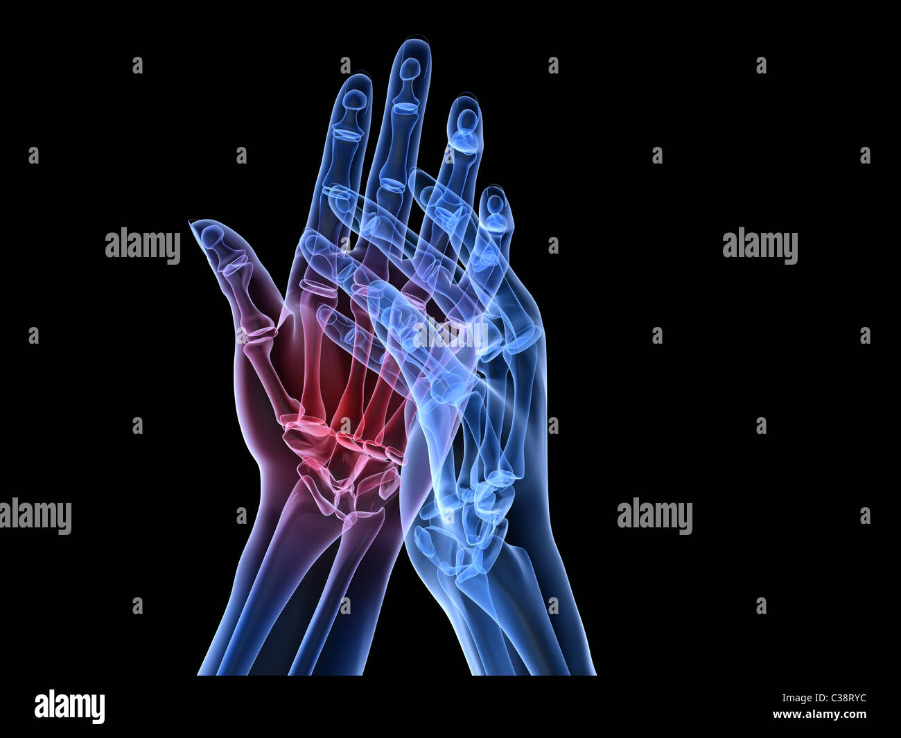 x-ray hands - arthritis Stock Photo - Alamy