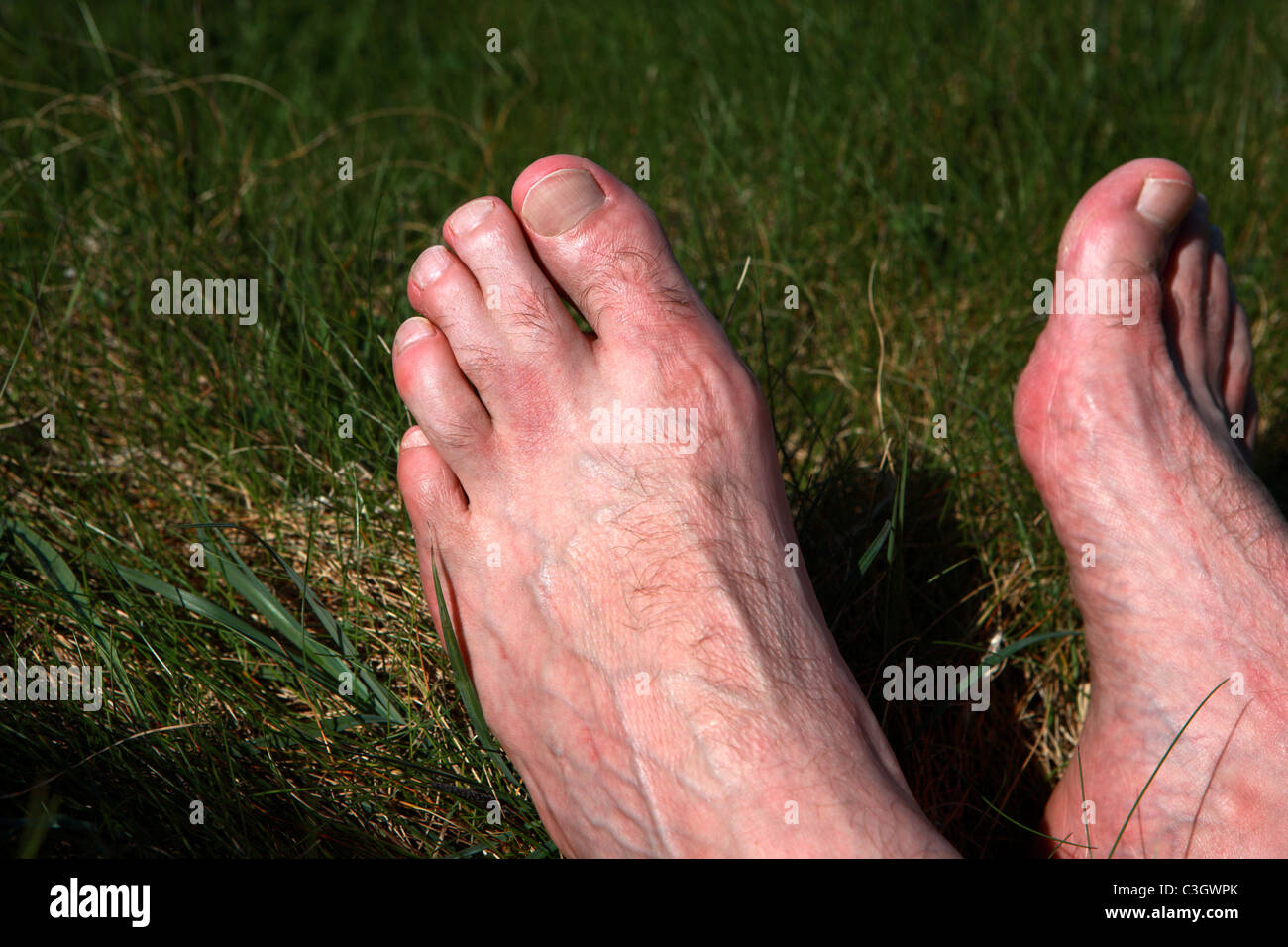 Man's feet with conjoined toes Stock Photo - Alamy