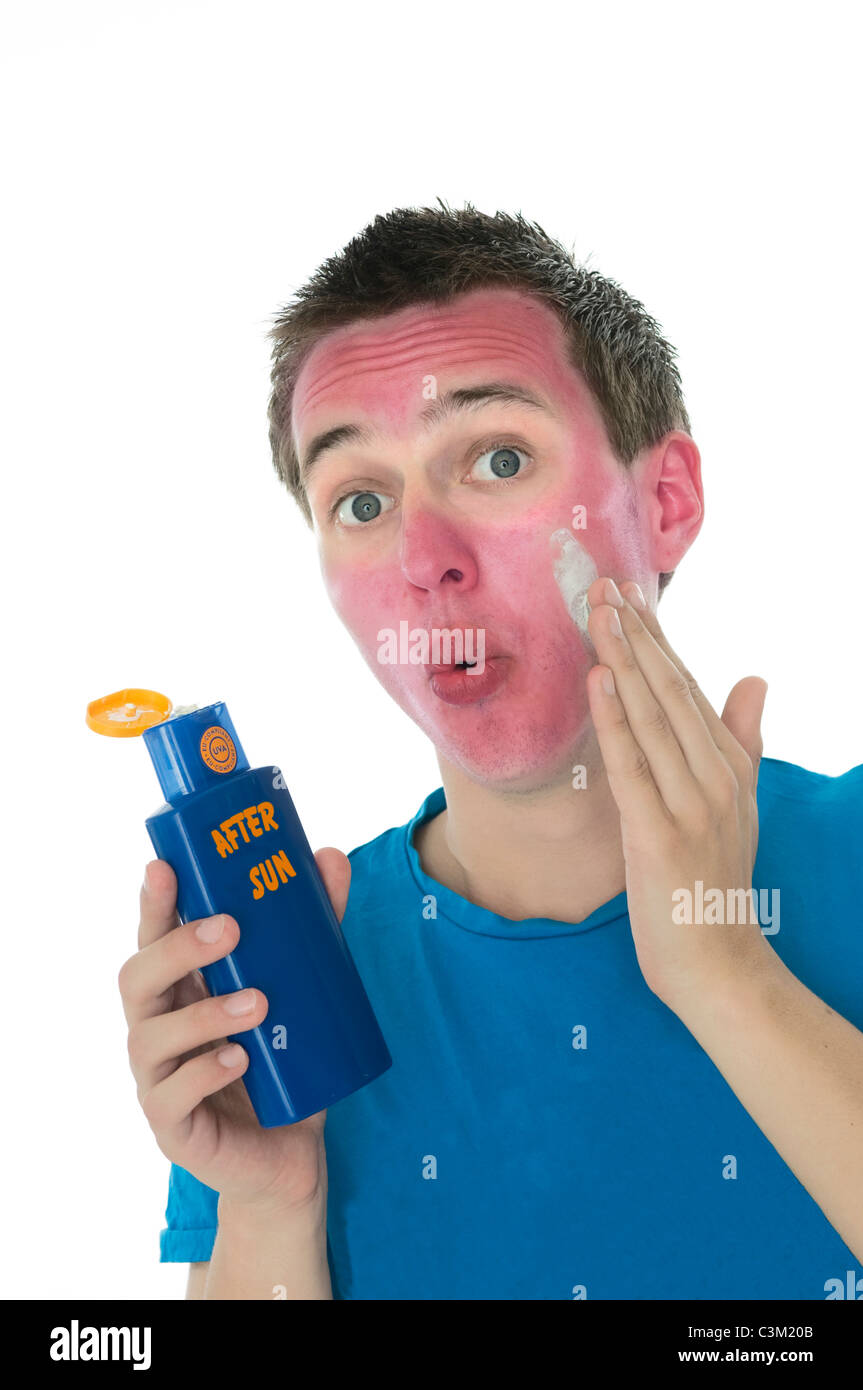 Young teen sunburn hi-res stock photography and images - Alamy