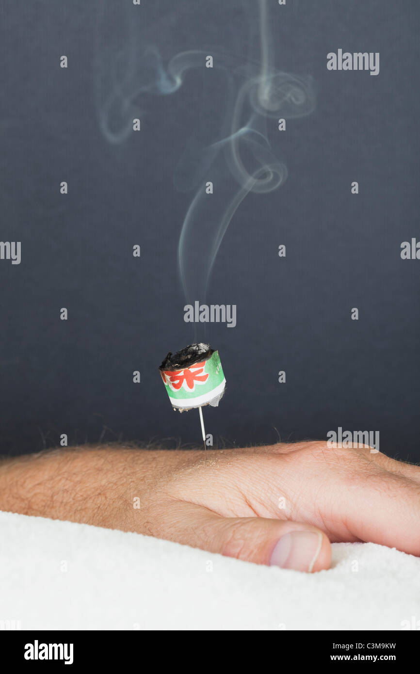 Man hand with moxa cigar burning on acupuncture needle Stock Photo - Alamy