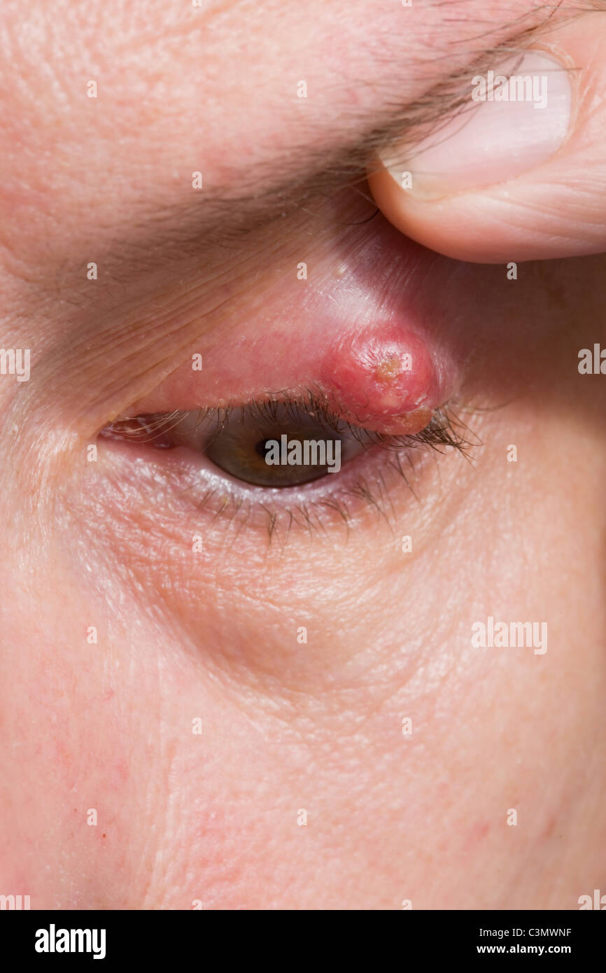 Cyst in eyelid hi-res stock photography and images - Alamy