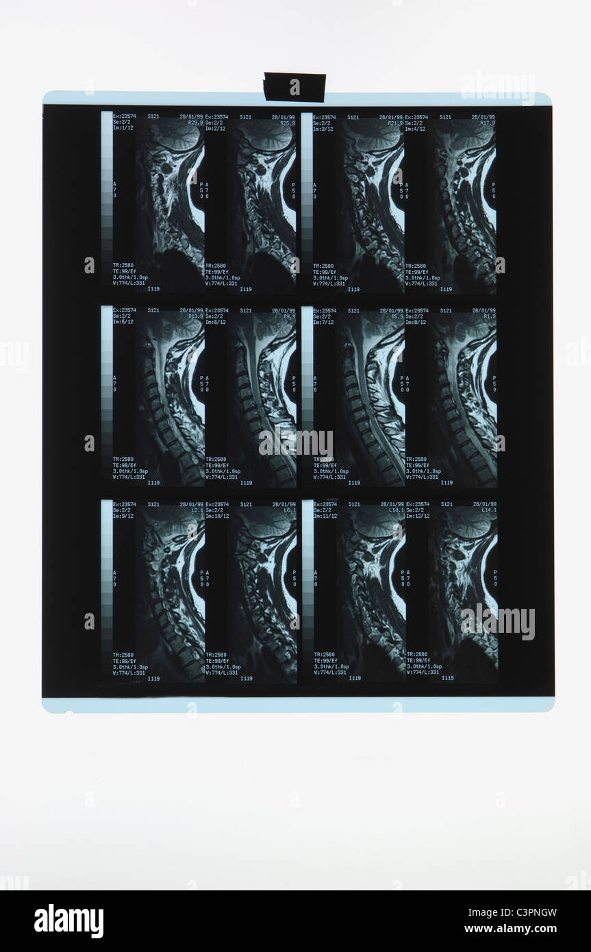 Ray spine neck hi-res stock photography and images - Alamy