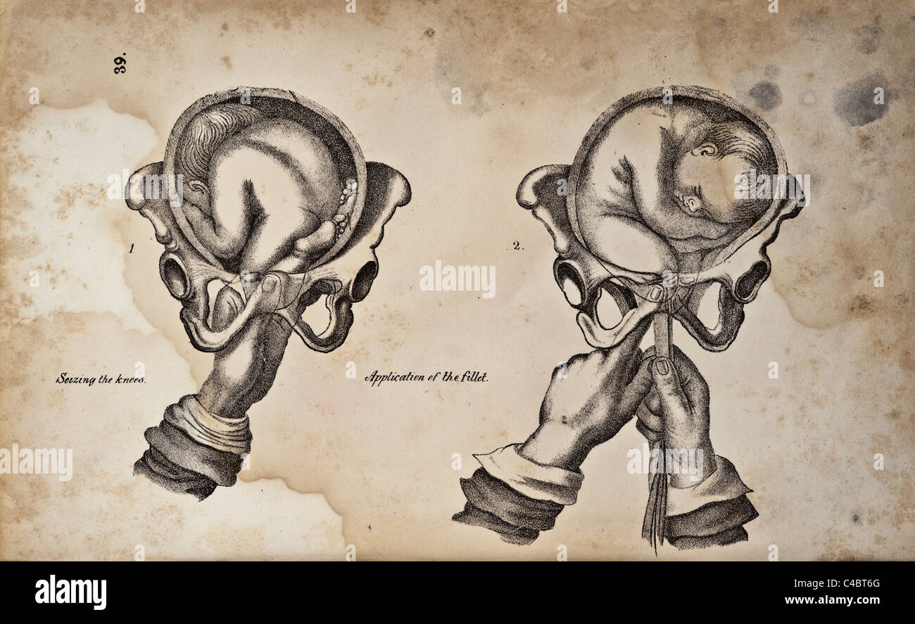 Birth Canal Illustration High Resolution Stock Photography and Images ...