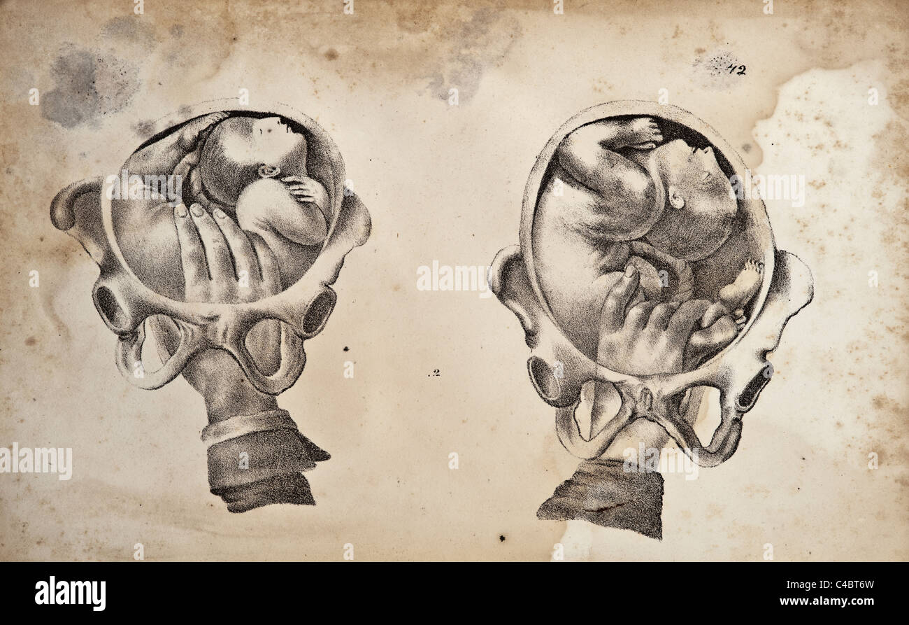 Illustration of Human Birth copyright 1844 Stock Photo - Alamy