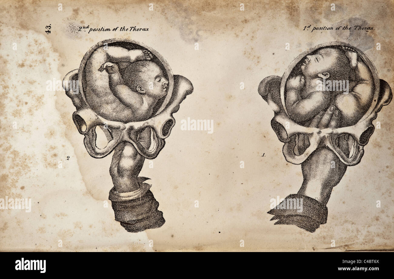 Illustration of Human Birth copyright 1844 Stock Photo - Alamy
