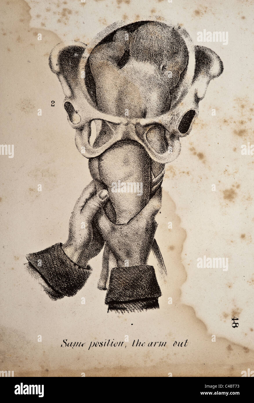 Illustration of Human Birth copyright 1844 Stock Photo - Alamy