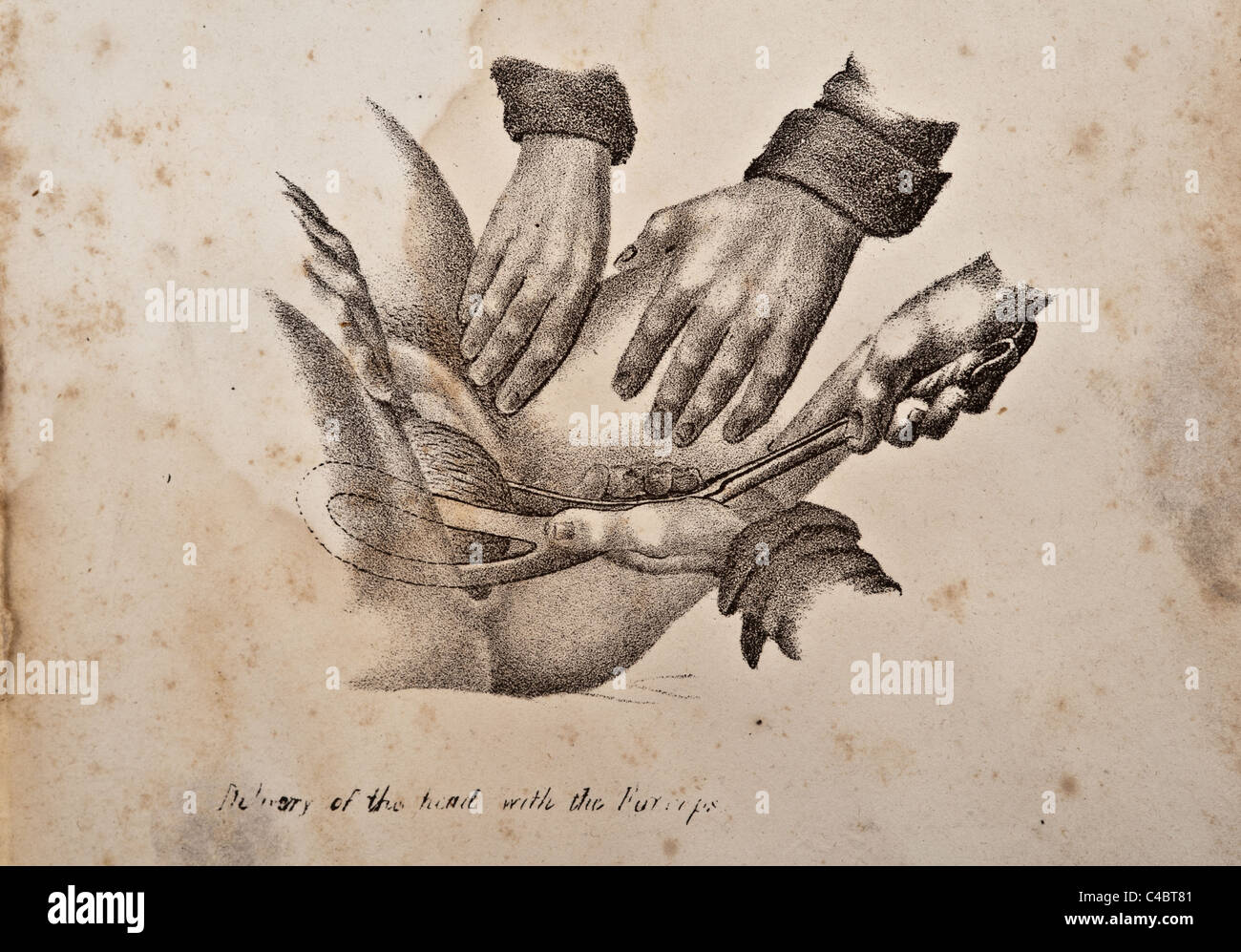 Illustration of Human Birth copyright 1844 Stock Photo - Alamy