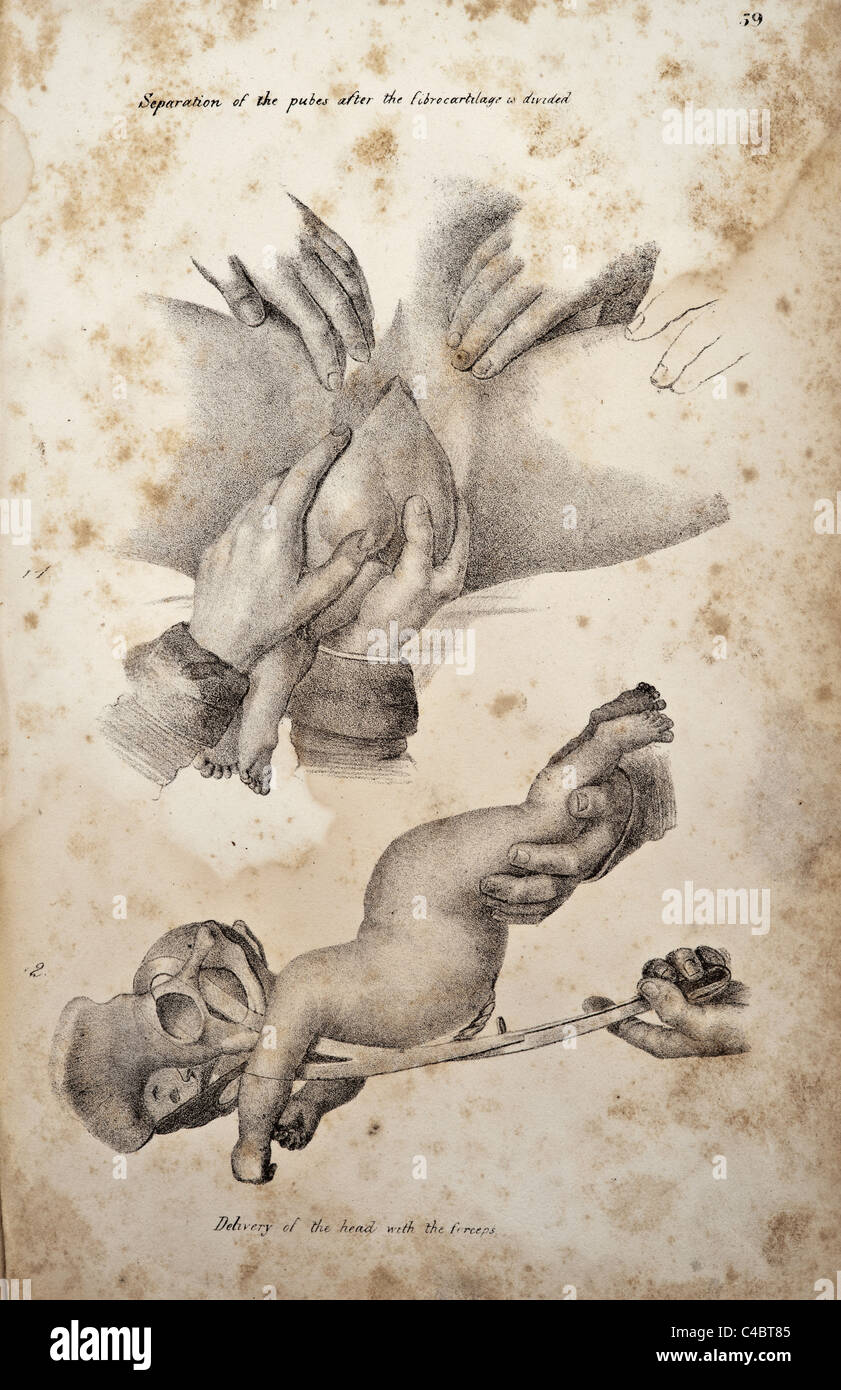 Illustration of Human Birth copyright 1844 Stock Photo - Alamy