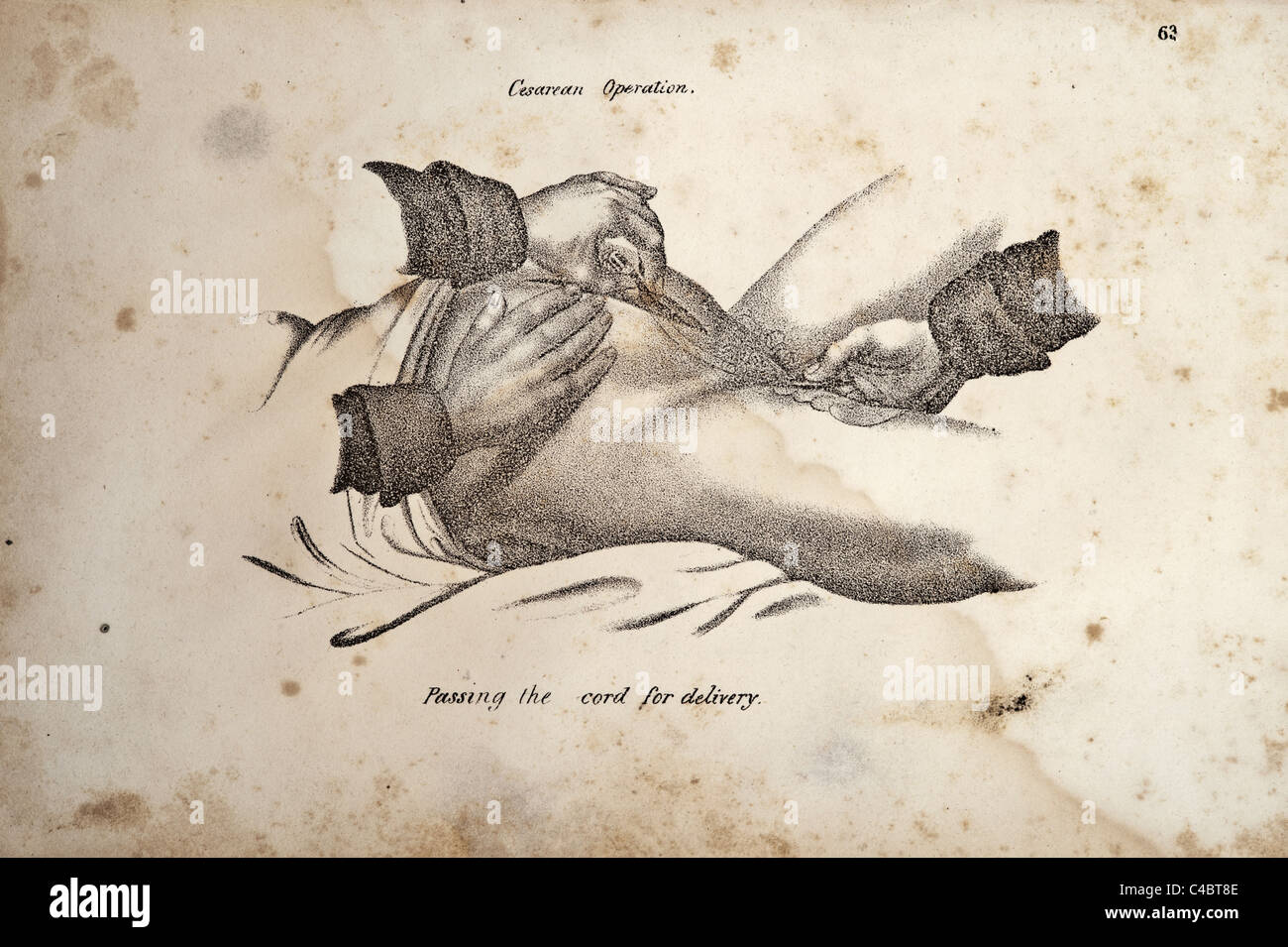 Illustration of Human Birth copyright 1844 Stock Photo - Alamy