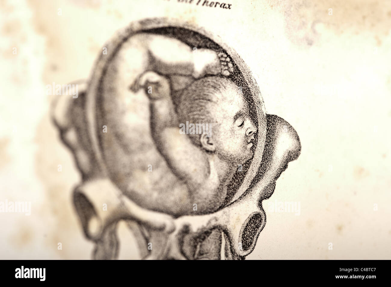 Breech birth hi-res stock photography and images - Alamy