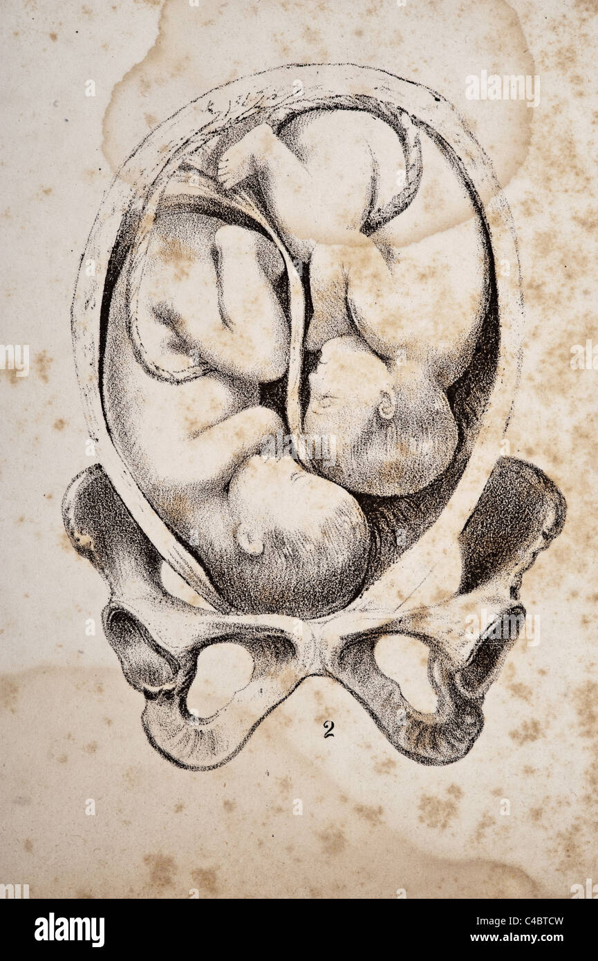 Twins womb hi-res stock photography and images - Alamy