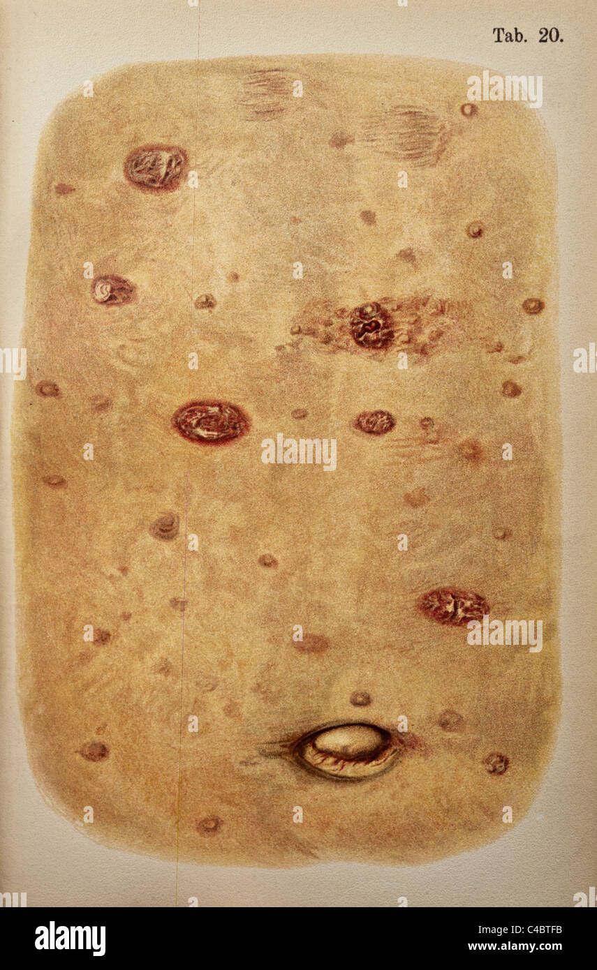 Illustration of Syphilitic Papules on the Human Skin copyright 1898 ...