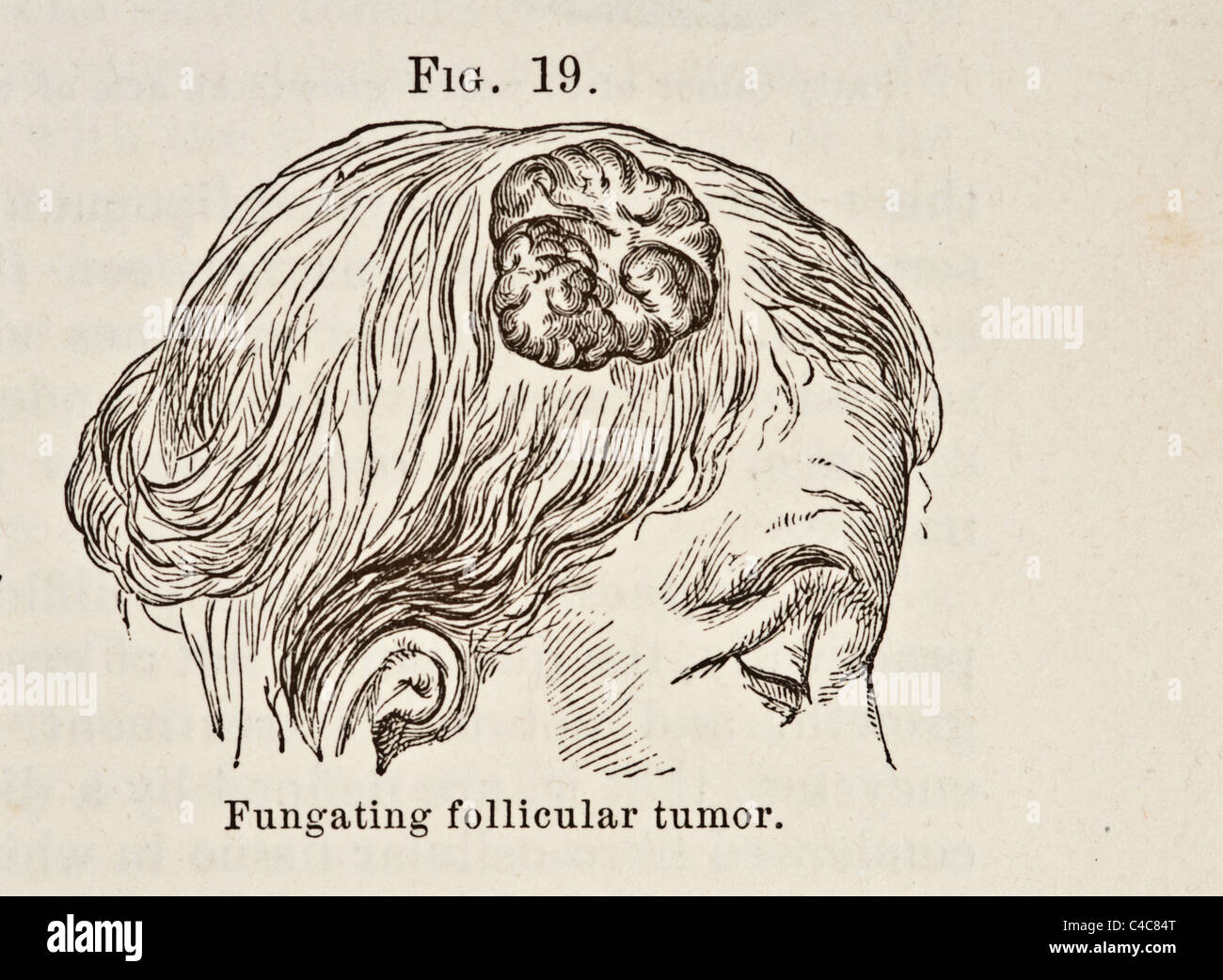 Illustration of Fungating Follicular Tumor circa 1882 Stock Photo - Alamy