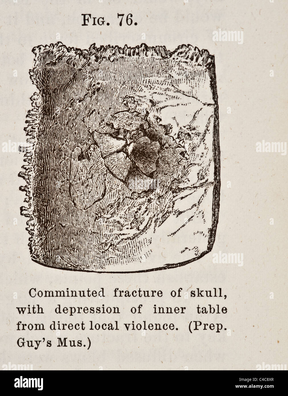 Cranial vault fracture hi-res stock photography and images - Alamy
